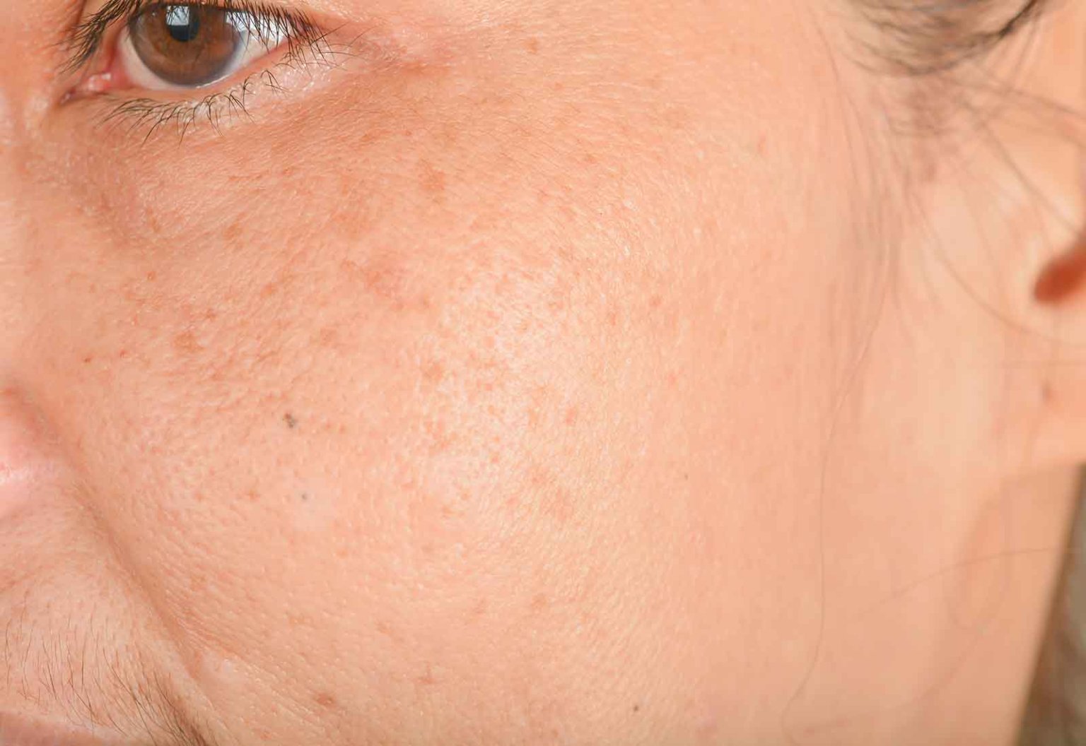 Lentigos en la Piel: Qué son y Cómo Prevenirlos | hedonai